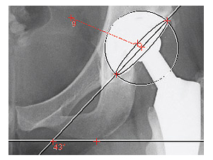 Stryker Corp Announces Compensation to Patients With Rejuvenated Hips