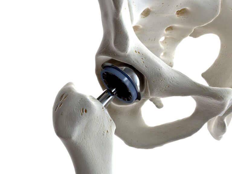 Wright Hip Replacement Recall & Lawsuit | Saunders & Walker P.A.