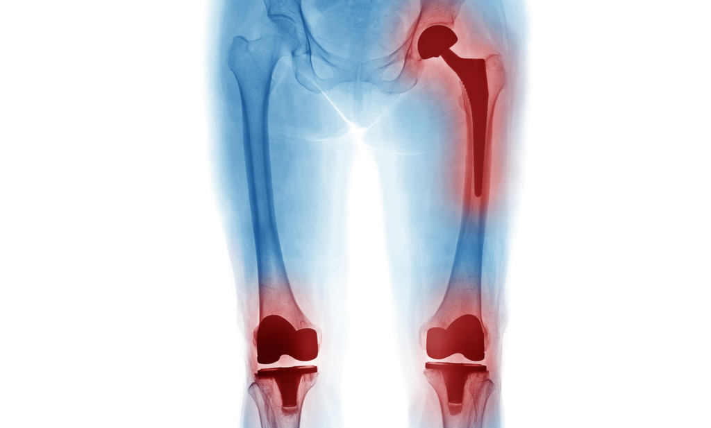 The Genesis and Development of the Exactech Orthopedic Hip and Knee ...