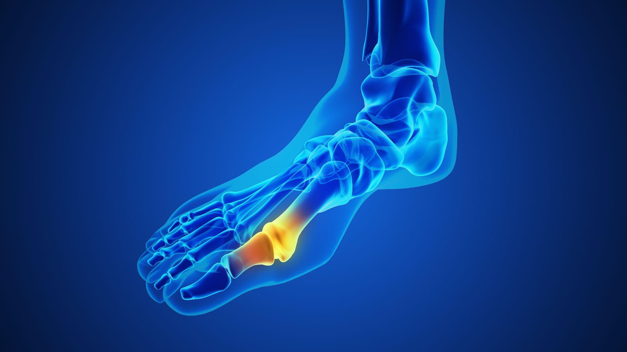 Can I Bring a Lawsuit for Compensation for My Cartiva Toe Implant ...