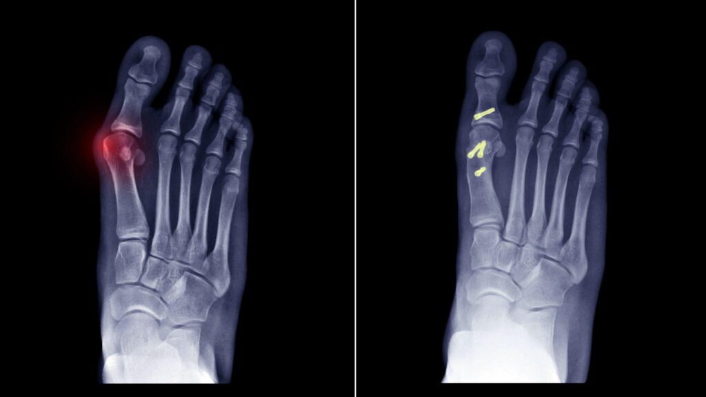 Can I Bring a Lawsuit for Compensation for My Cartiva Toe Implant ...